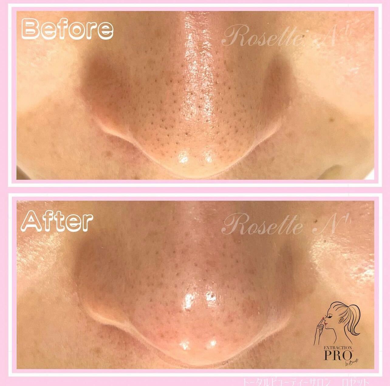 EXTRAXCTION PRO | Rosette N"